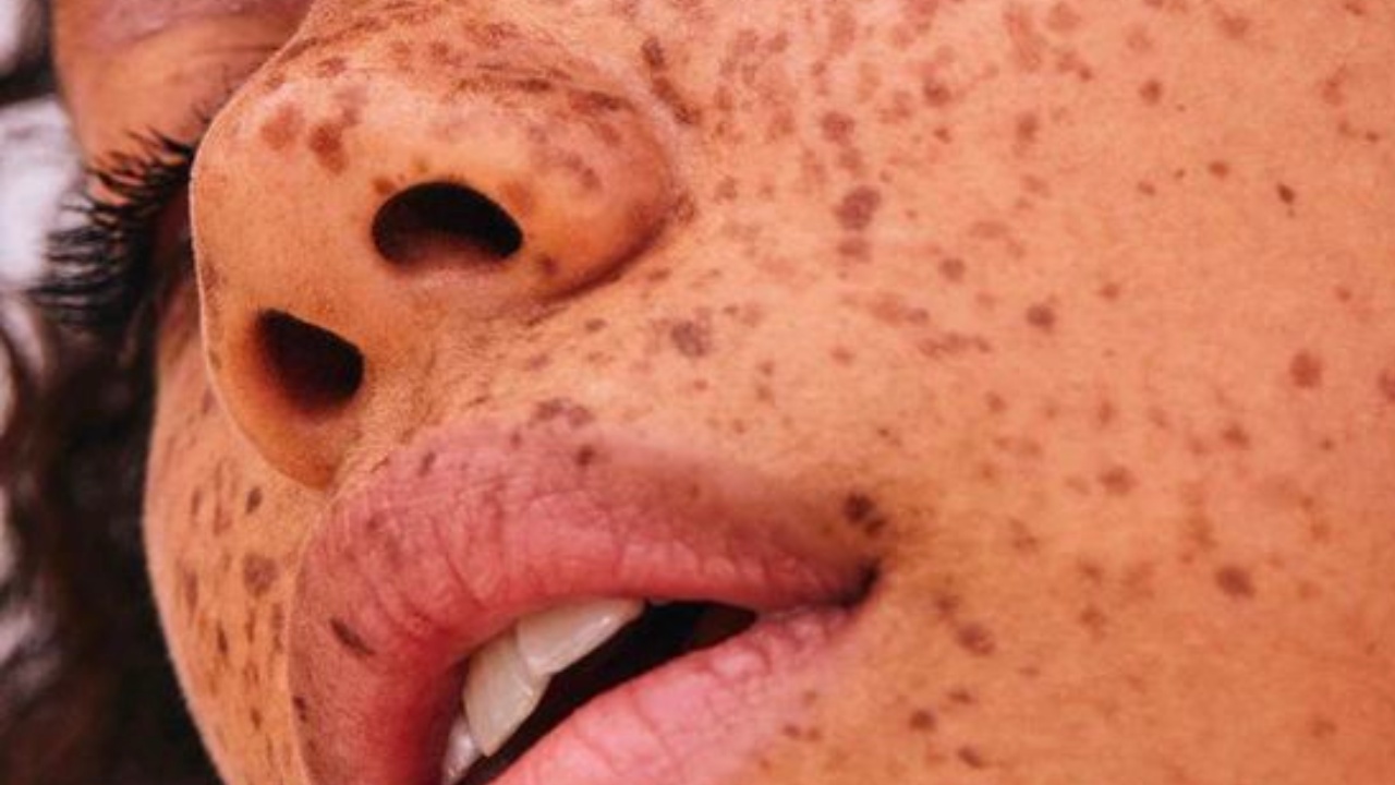 Malassezin: The New Beauty Ingredient You Need To Know