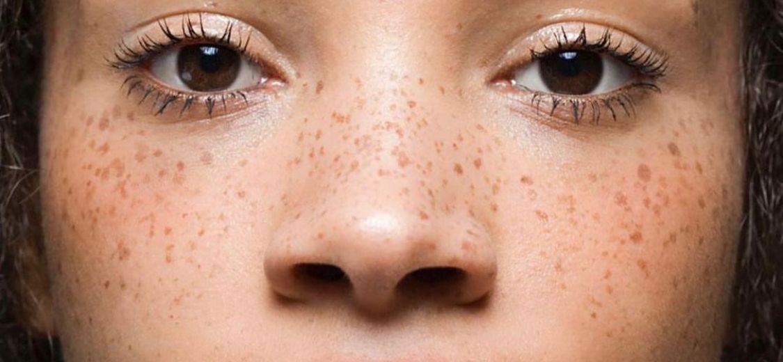 Freckling: La técnica semipermanente para tener pecas en tu rostro ...