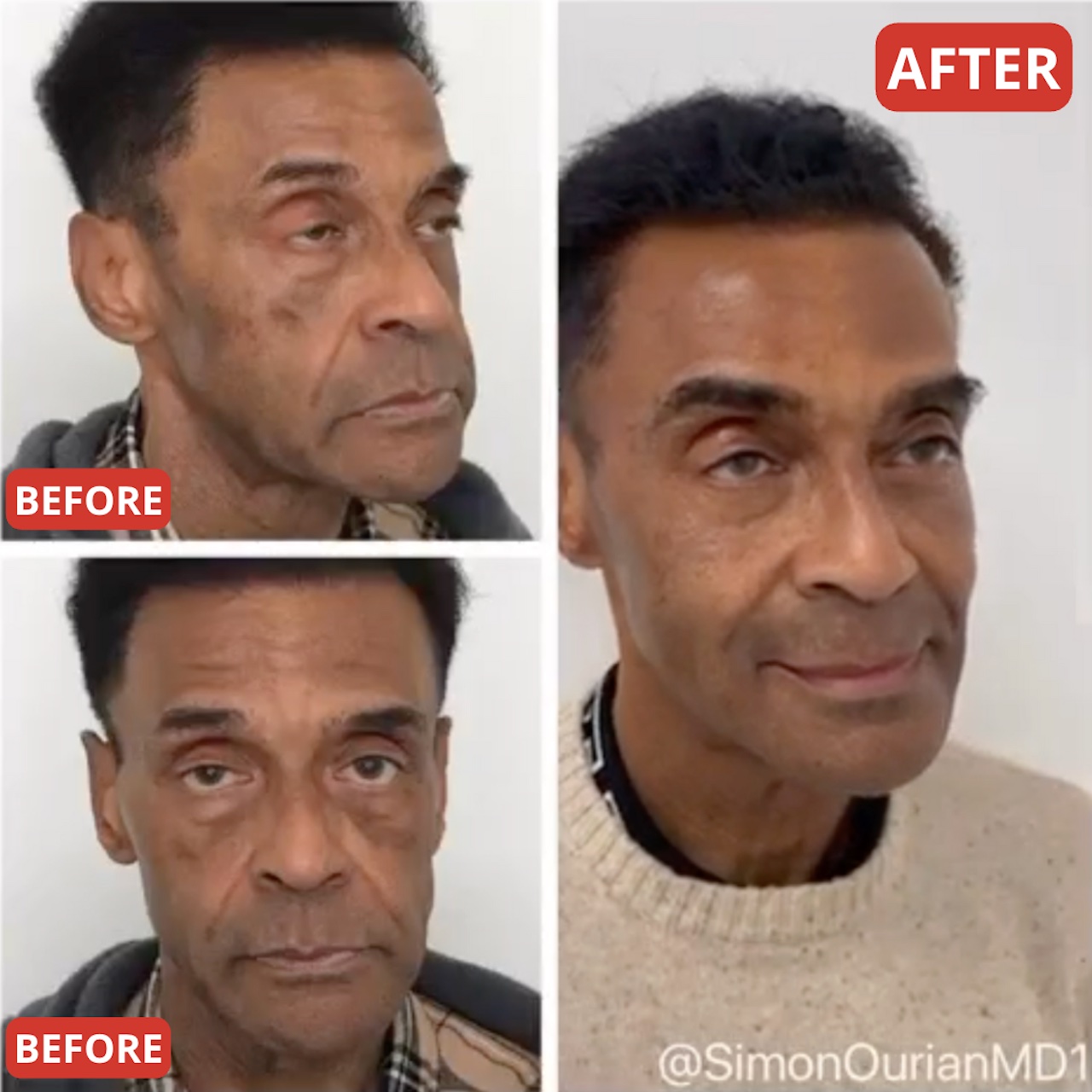 Dr. Simon Ourian’s Non-Surgical Facelifts