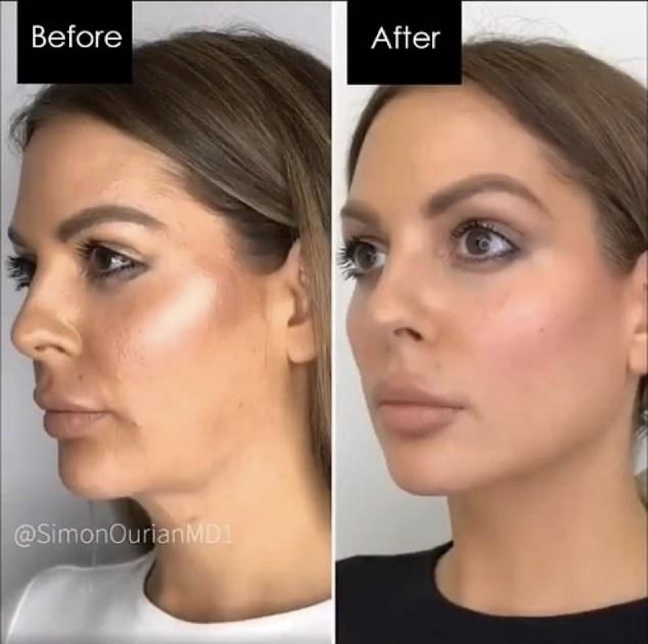 Dr. Simon Ourian’s Non-Surgical Facelifts