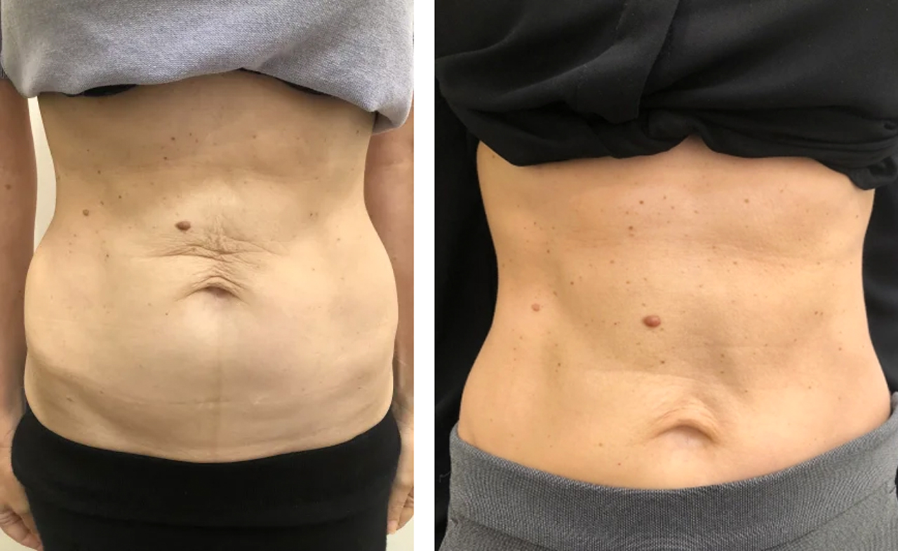 BBL Hero Treatment: Everything You Need To Know - Grazia