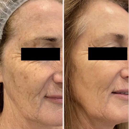 BBL Hero Treatment: Everything You Need To Know - Grazia